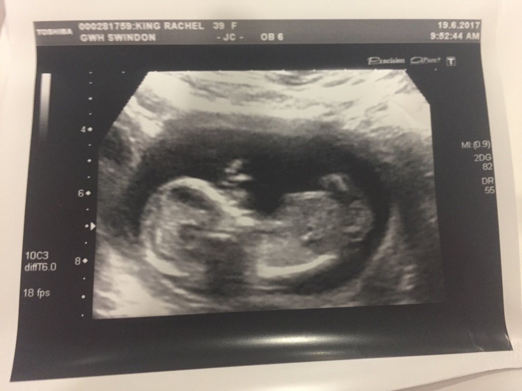 12 week scan next week! - Page: 3