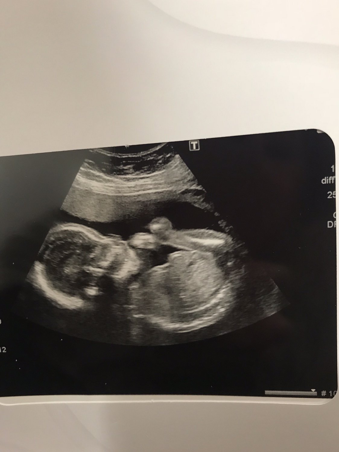 Anyone any good at guessing genders from 20 week scan photos?