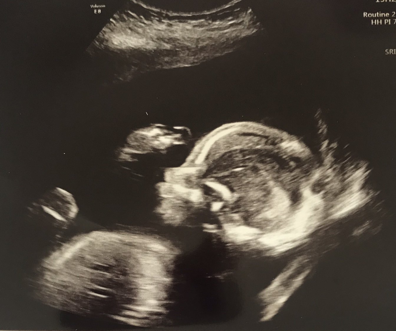 Anyone any good at guessing genders from 20 week scan photos?