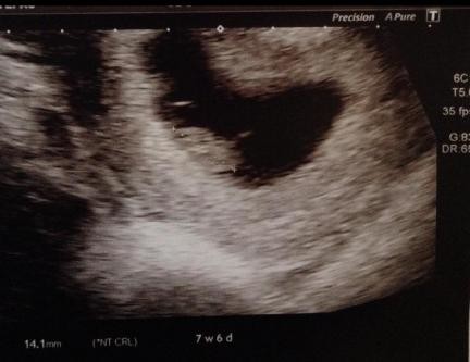 Scan at 8 weeks - what to expect?