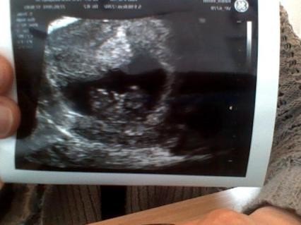 Scan at 8 weeks - what to expect?