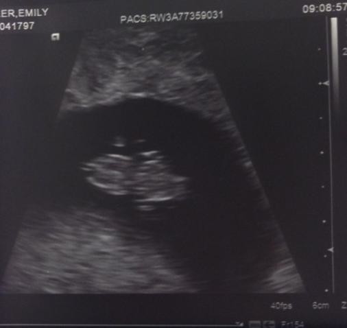 Scan at 8 weeks - what to expect?