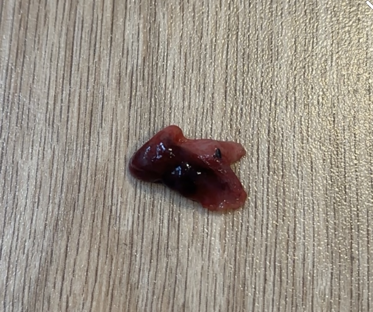 Blood Clot Vs Miscarriage Tissue