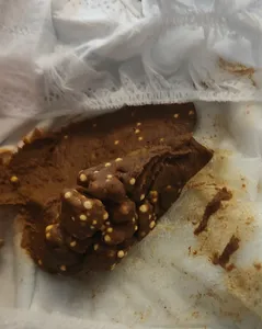 White balls in stool