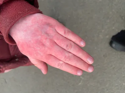 5 year mottled hands, face and feet when walkinf