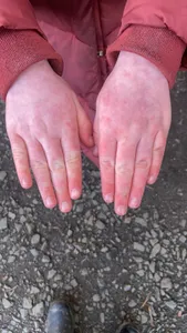 5 year mottled hands, face and feet when walkinf
