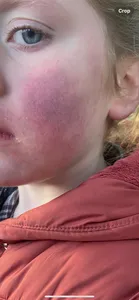 5 year mottled hands, face and feet when walkinf