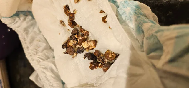 Toddler Poop - Does This Look Normal?