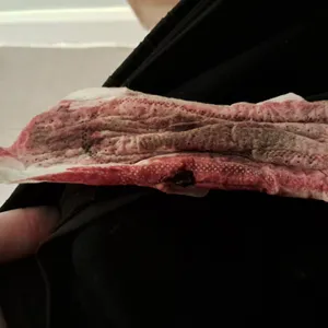 second pregnancy bleed